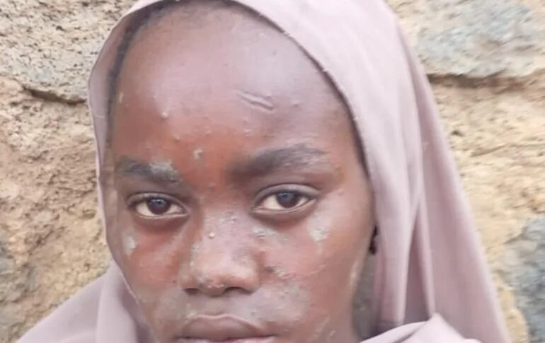 Mpox outbreak, malnutrition surge among IDPs in Jebel Marra - Sudan ...